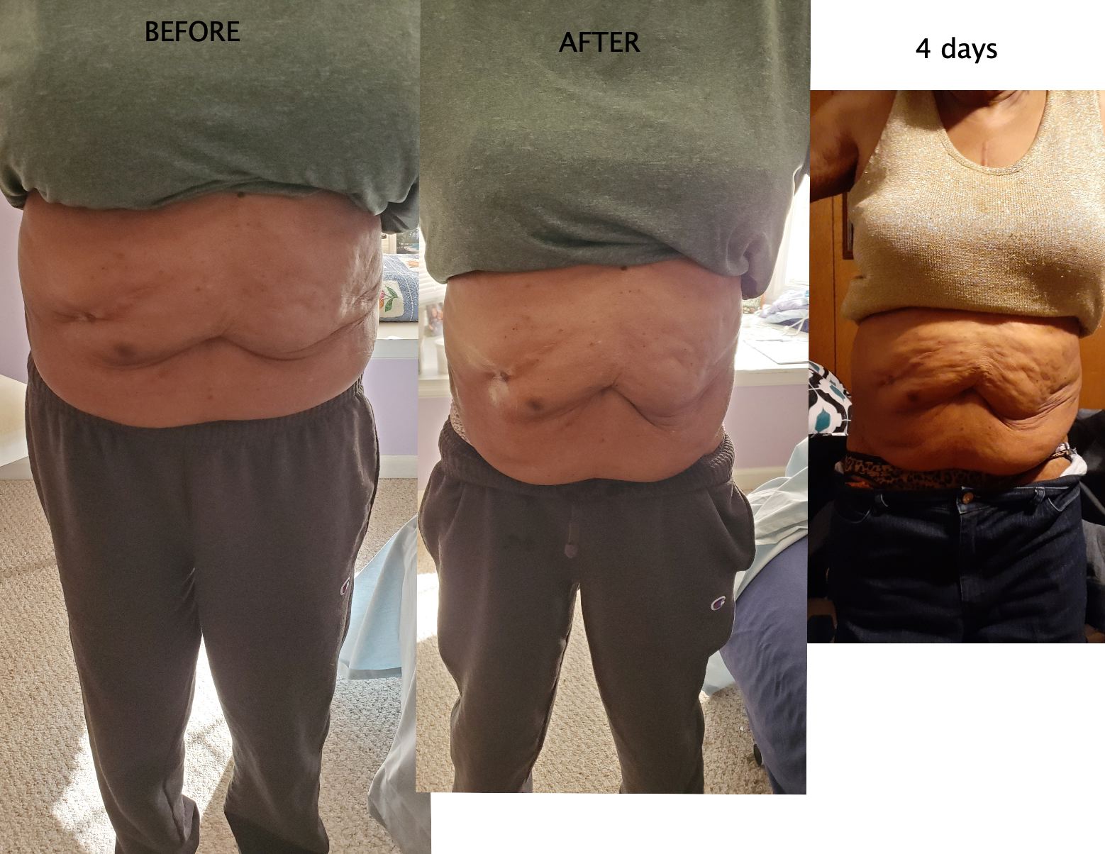 Ultrasound Cavitation | WHOLE BODY HEALTHCARE & WELLNESS LLC